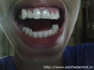 Namamagang gums, pasta at braces – Ask the Dentist