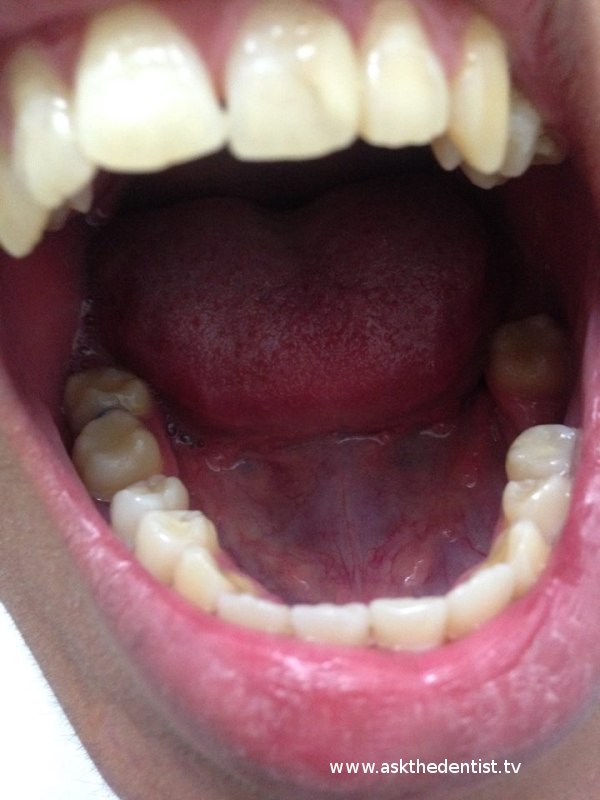 Gusto ng braces at implant pero namamaga ang gilagid – Ask the Dentist