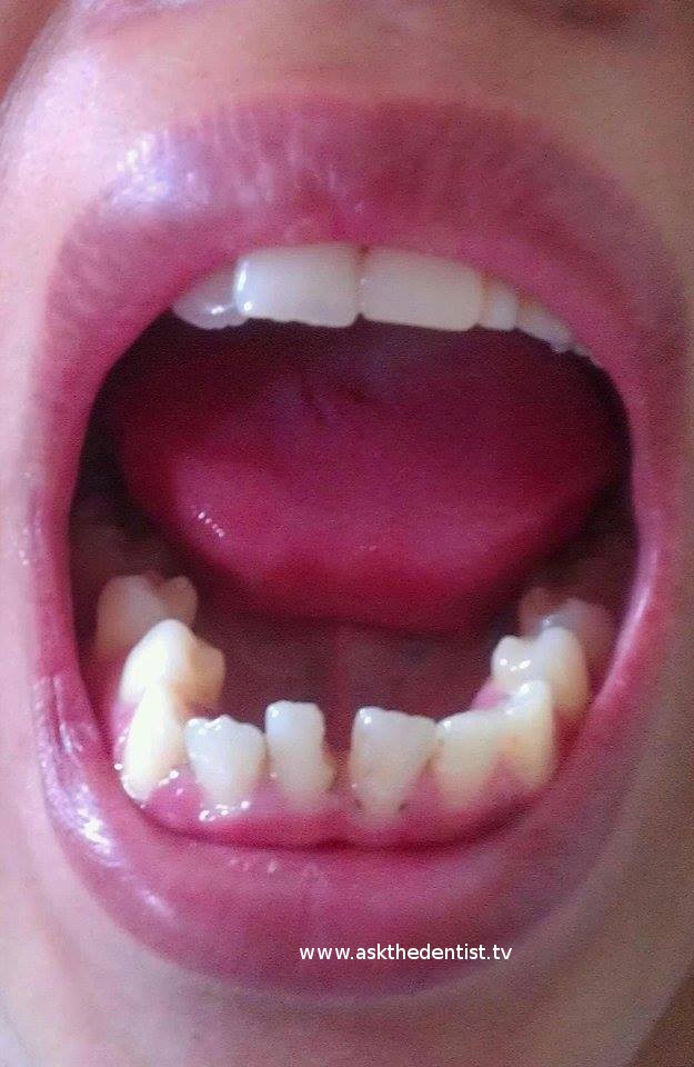 Maaayos ba ng Braces ang Sungki – Ask the Dentist